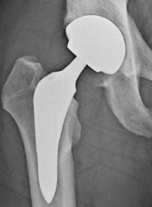 Total Hip Replacement - Jared Lee, MD